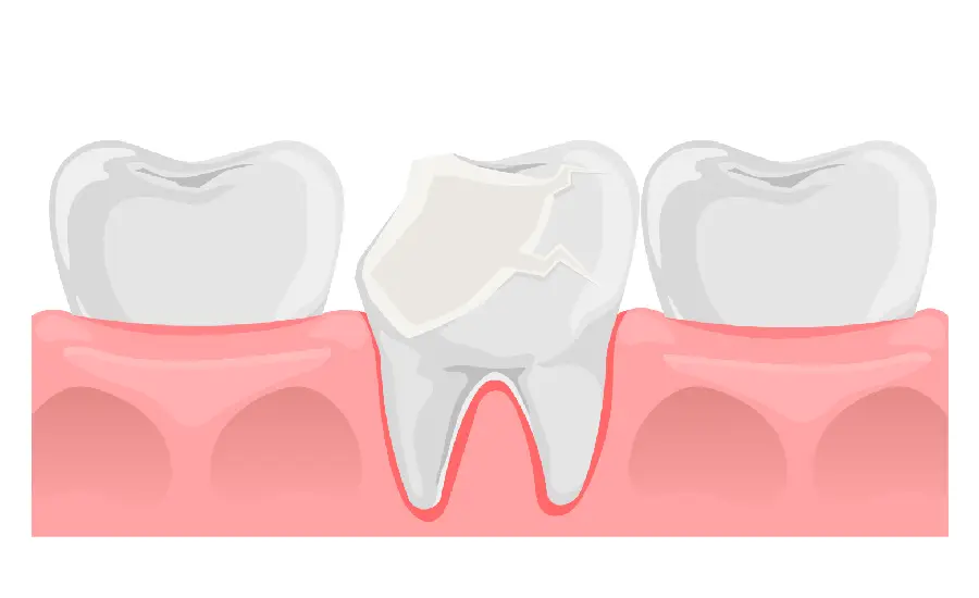 Can a Cracked Tooth Heal Naturally? Treatment Options Explained Myra ...